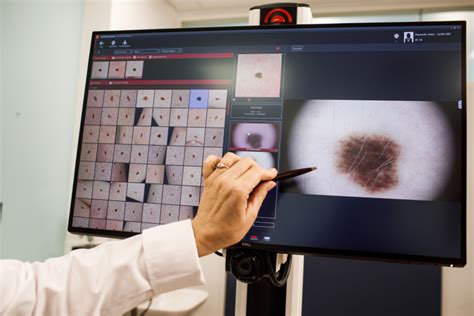 Mole Mapping – North York Dermatology Clinic